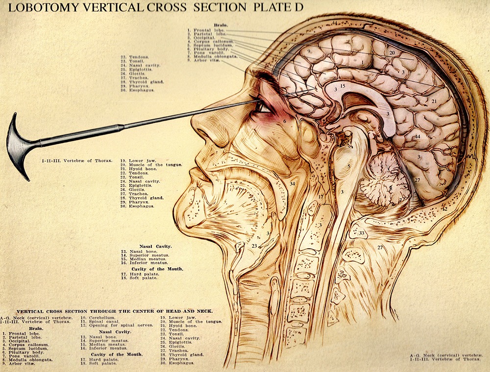 lobotomy diagram - MyConfinedSpace